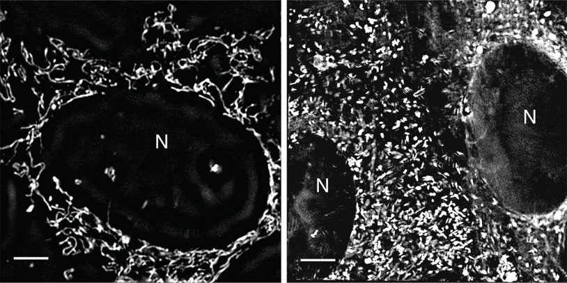 Study reveals a way to make prostate cancer cells run out of energy and ...