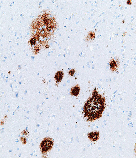 Scientists reverse Alzheimer’s-like memory loss in animal models by ...